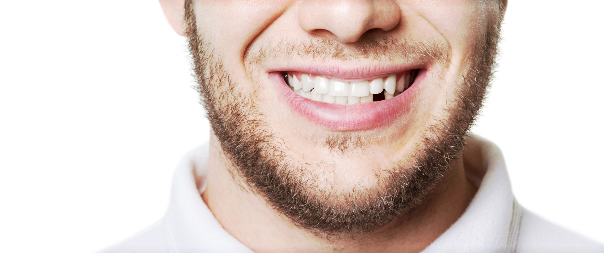 Perdi um dente e não quero fazer implante: veja quais são as ...